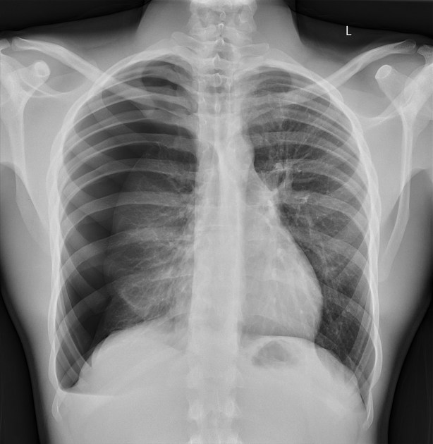 A 28-year-old male presents with sudden-onset chest pain and shortness ...