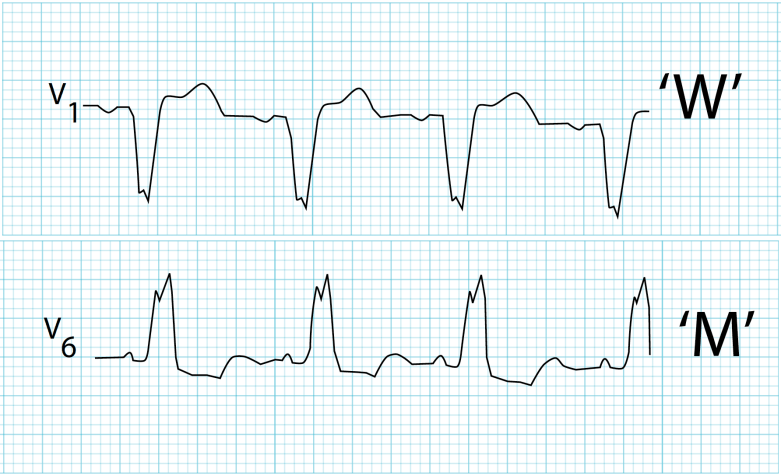 Understanding Left Bundle Branch Block in Heart Failure – Simon R. Downes